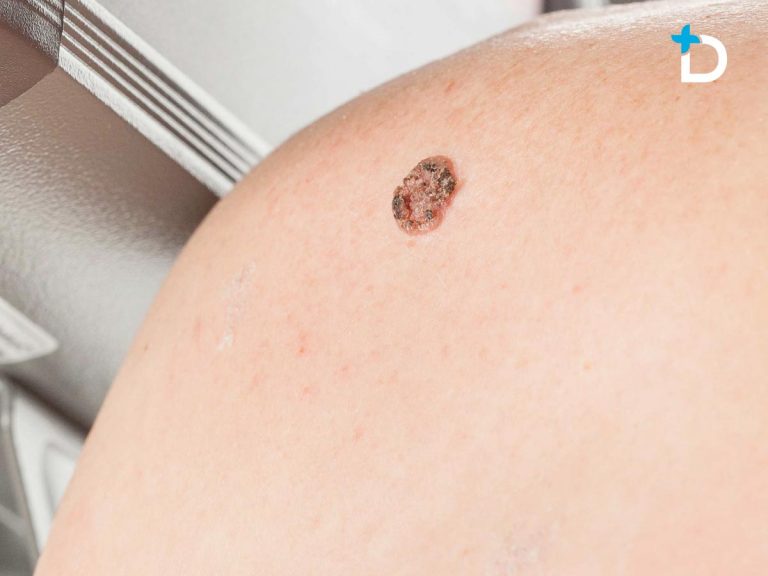 Carcinoma Escamocelular Dermas Colombia
